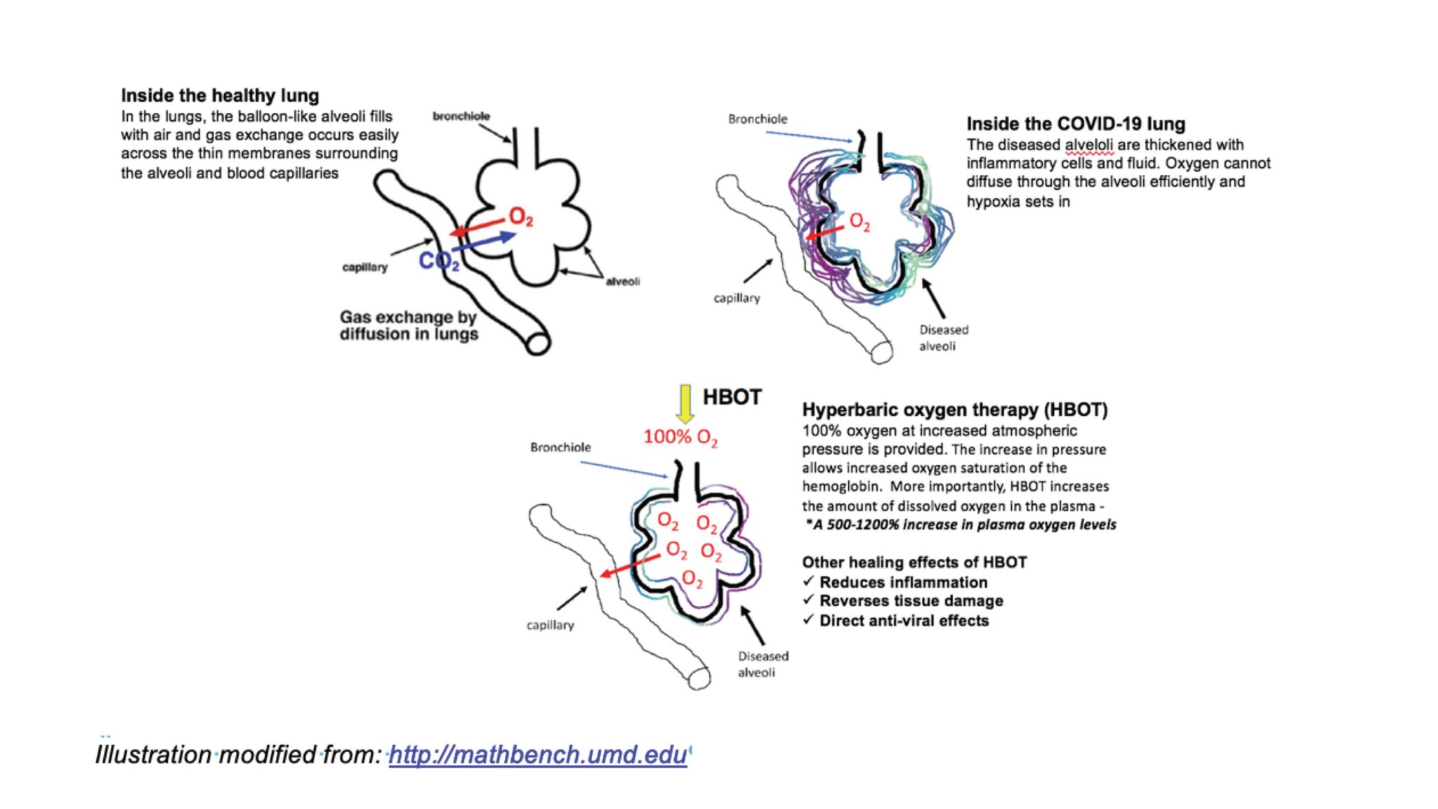 HBOT for the Treatment of Severe COVID-19 Disease - Island Hyperbaric ...